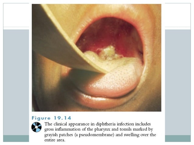 Diphtheria. Differential diagnostics of Acute tonsillitis | PPT
