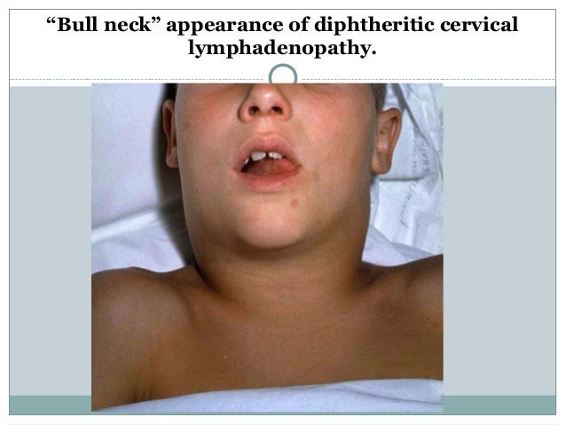 Diphtheria. Differential diagnostics of Acute tonsillitis