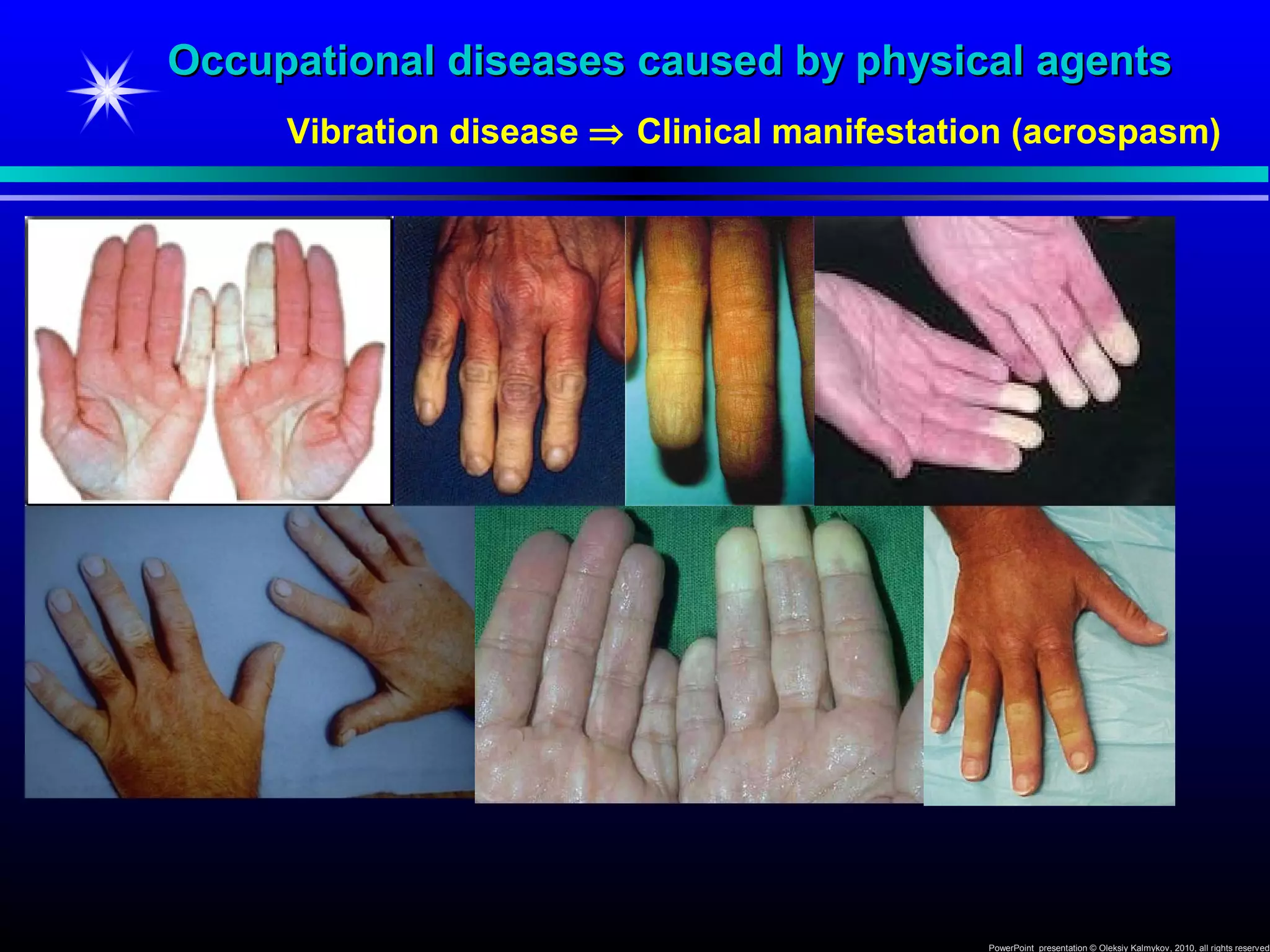 Vibration Disease caused by Physical agents | PPT