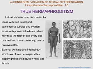 Diseases of Gonads | PPT