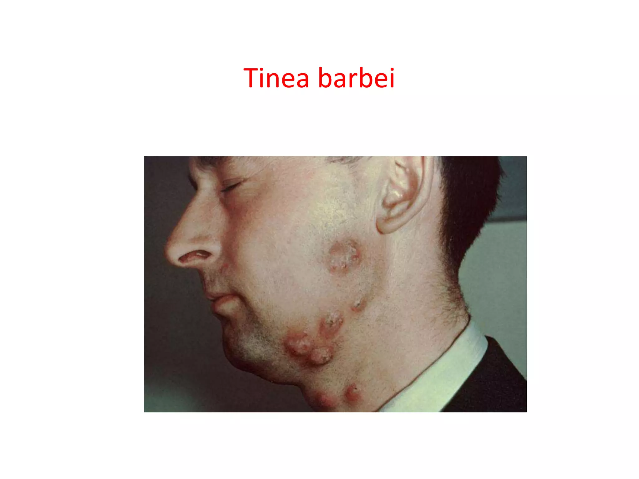 Superficial Mycoses | PPTX | Skin and Dermatology | Diseases and Conditions