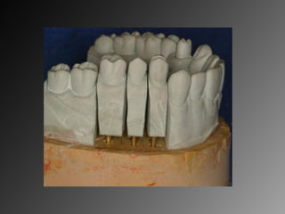 Dental Cast Die