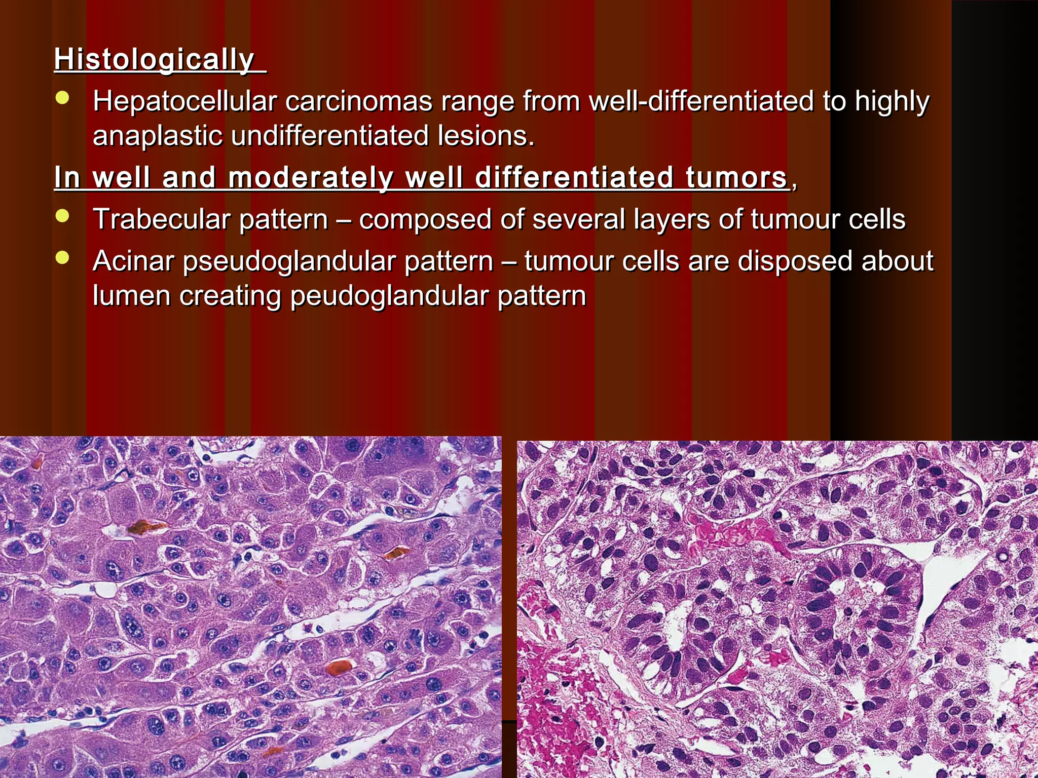 8.hepatocellular carcinoma | PPT