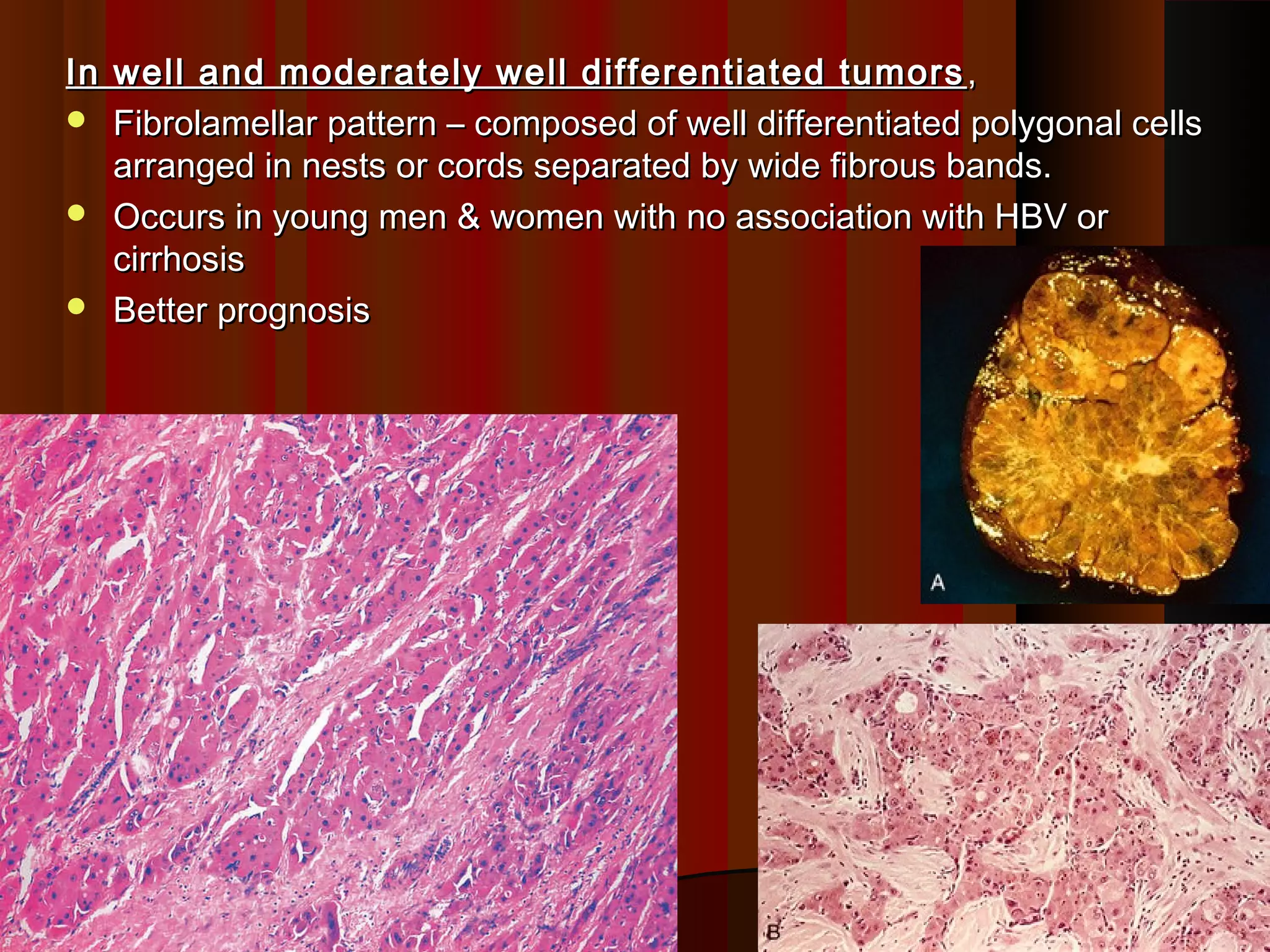 8.hepatocellular carcinoma | PPT