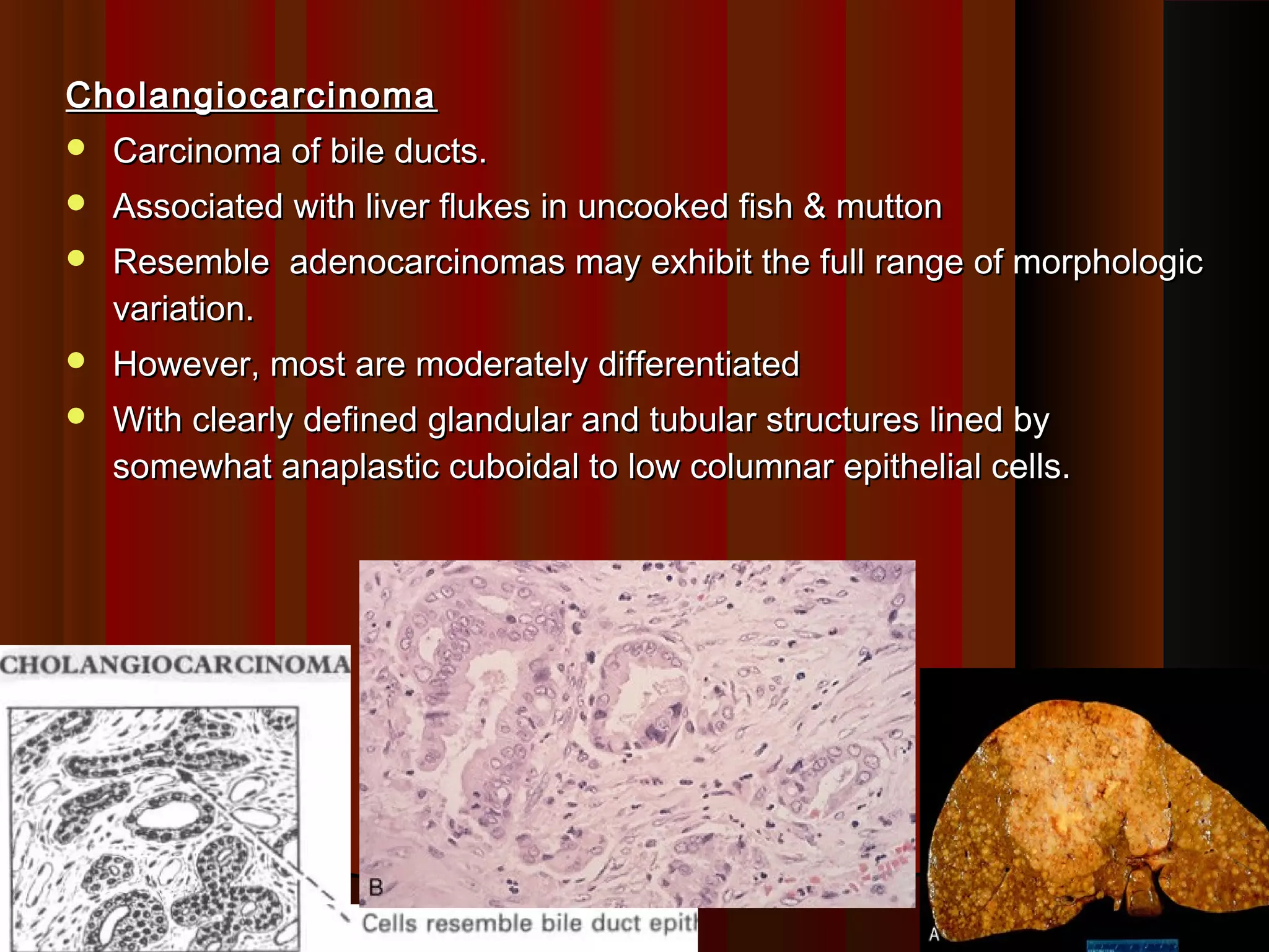 8.hepatocellular carcinoma | PPT