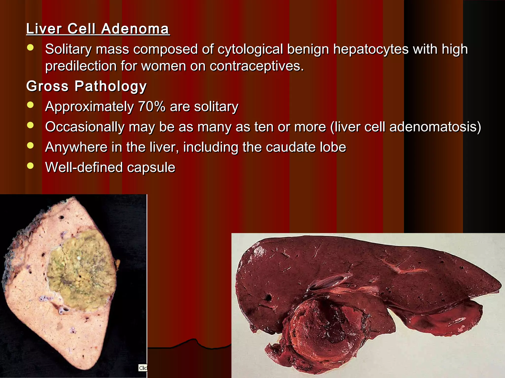 8.hepatocellular carcinoma | PPT