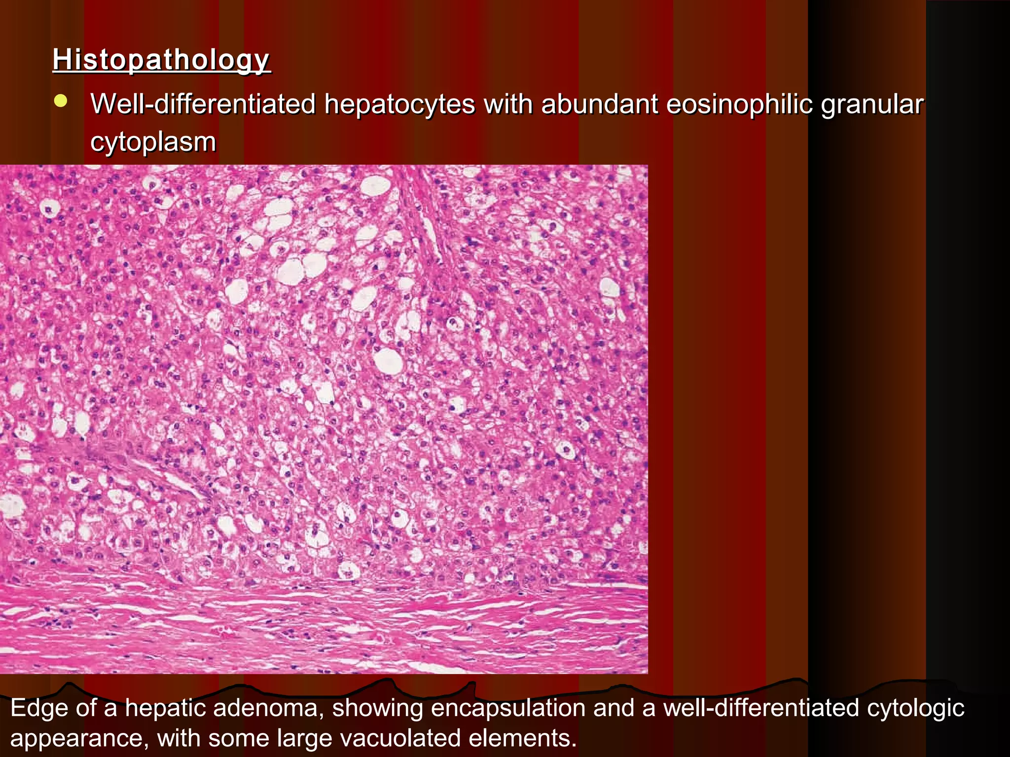 8.hepatocellular carcinoma | PPT