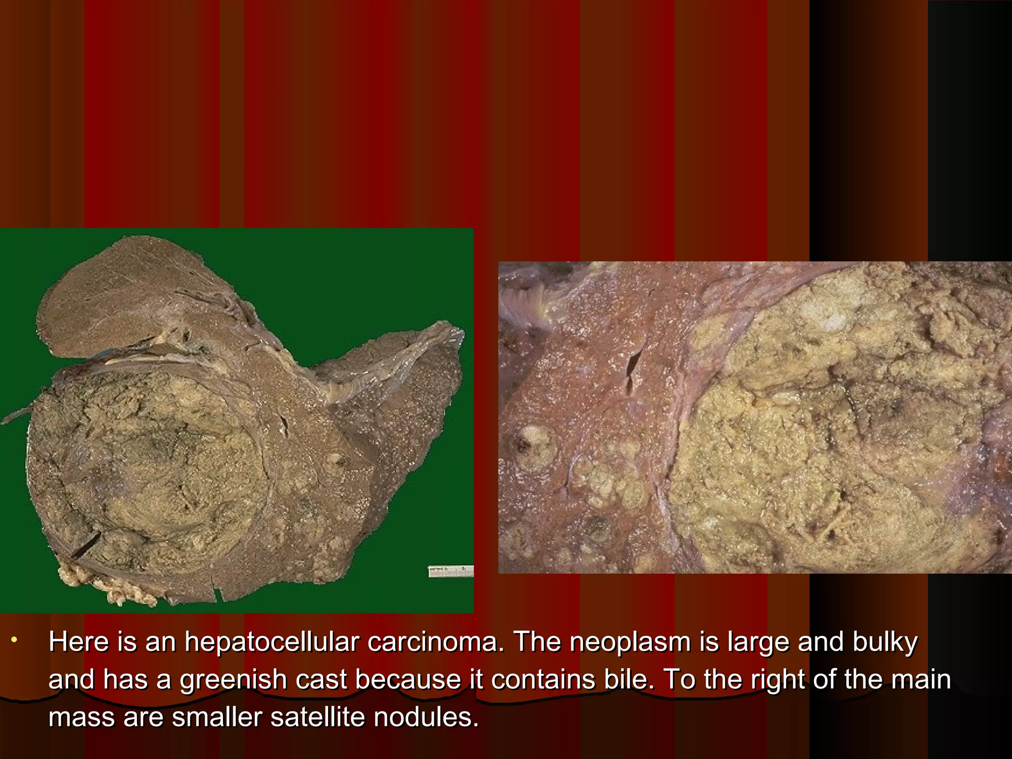 8.hepatocellular carcinoma | PPT