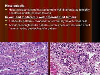 8.hepatocellular carcinoma | PPT