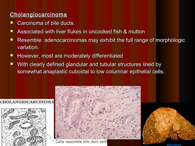8.hepatocellular carcinoma | PPT | Cancer | Diseases and Conditions
