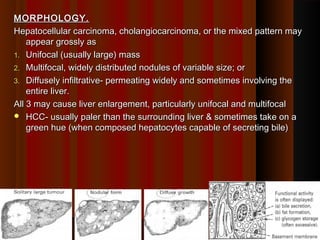 8.hepatocellular carcinoma | PPT