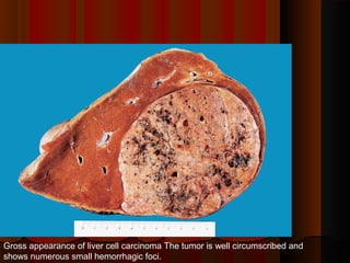 8.hepatocellular carcinoma | PPT | Cancer | Diseases and Conditions