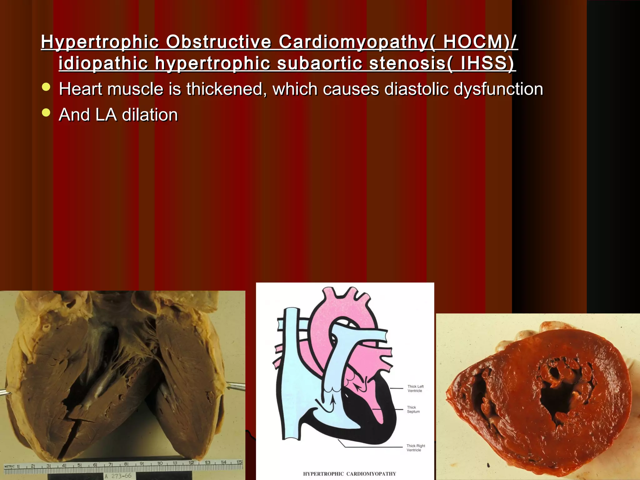 8. Disease of myocardium | PPT