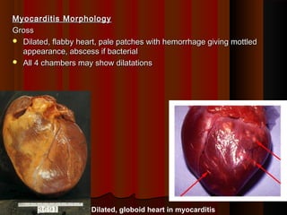 8. Disease of myocardium | PPT