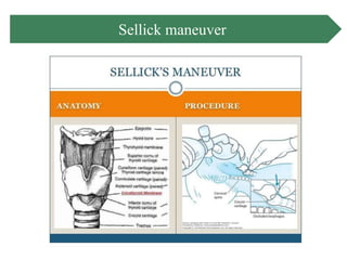 Airway management | PPTX