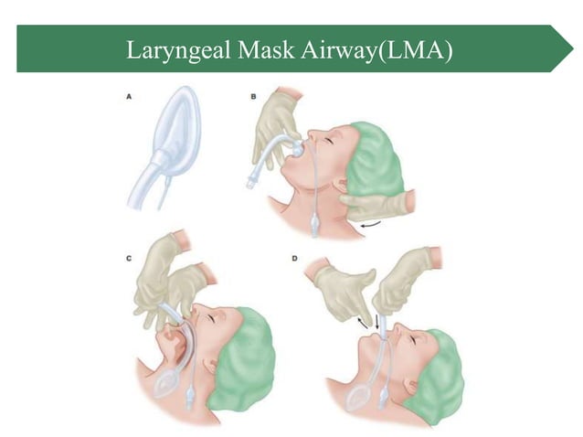 Airway management | PPTX | Ear, Nose and Throat Conditions | Diseases ...