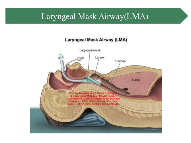 Airway management