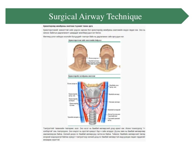 Airway management