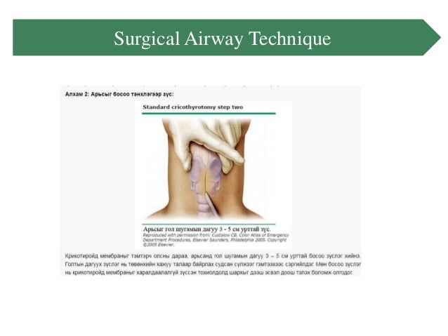 Airway management
