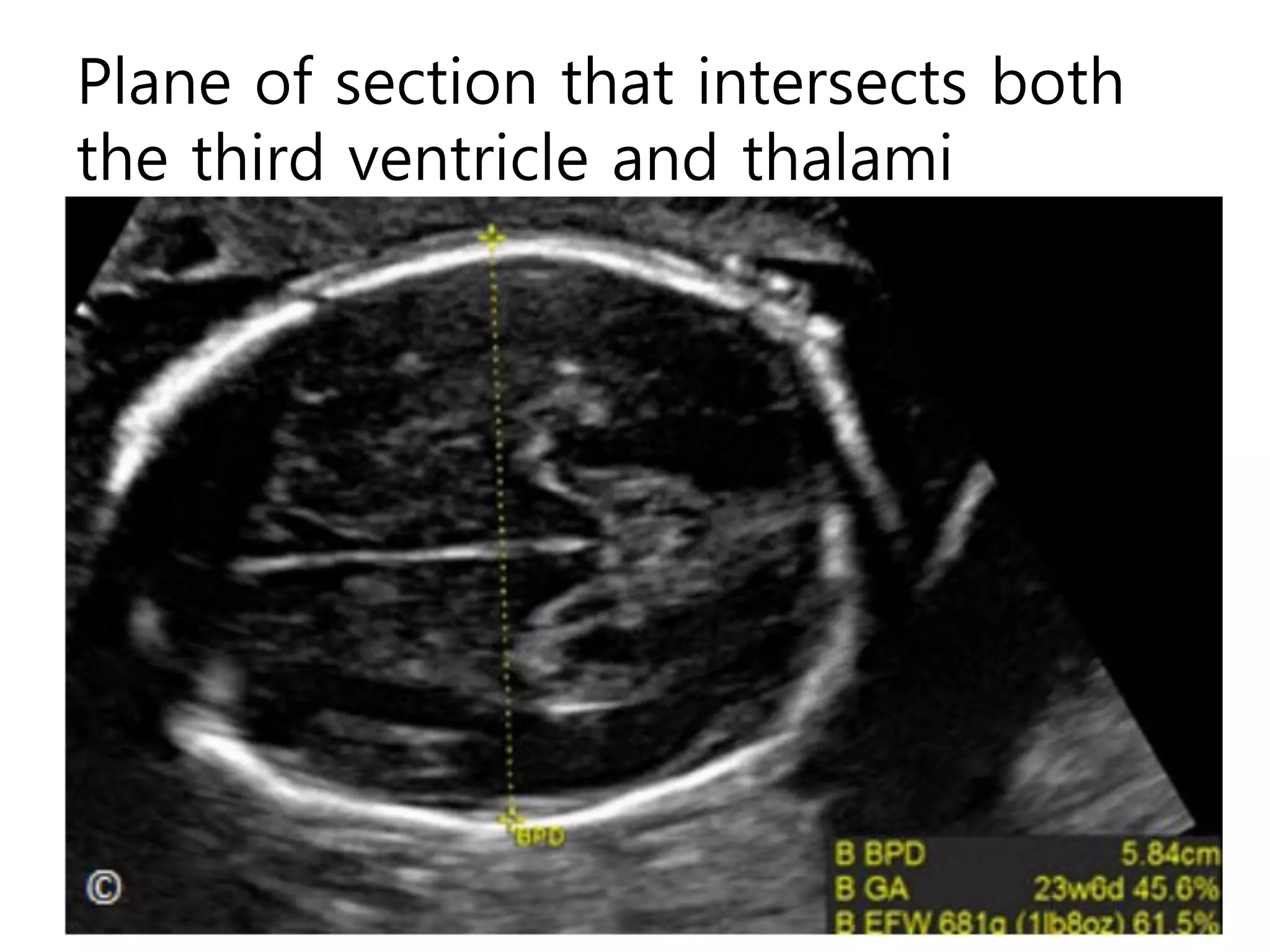 8. normal second trimester ultrasound | PDF