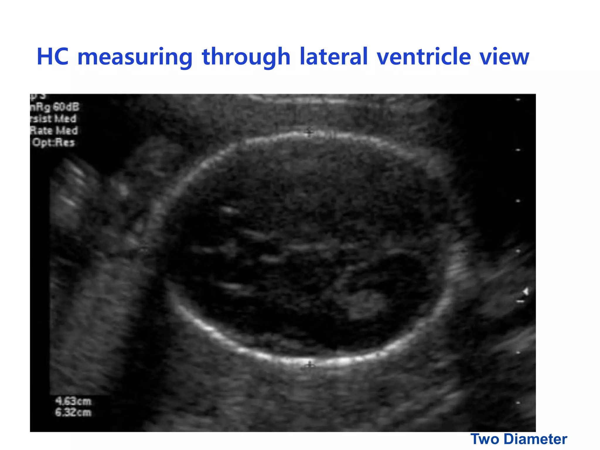 8. normal second trimester ultrasound | PDF