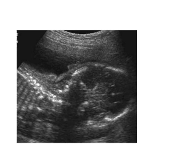 8. normal second trimester ultrasound | PDF | Pregnancy | Reproductive ...