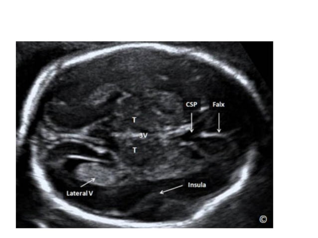 8. normal second trimester ultrasound | PDF | Pregnancy | Reproductive ...