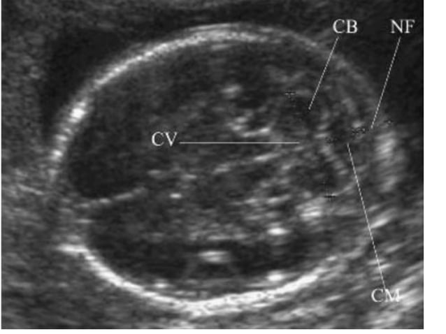 8. normal second trimester ultrasound | PDF | Pregnancy | Reproductive ...