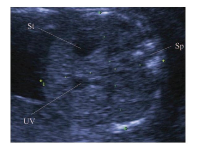 8. normal second trimester ultrasound | PDF | Pregnancy | Reproductive ...
