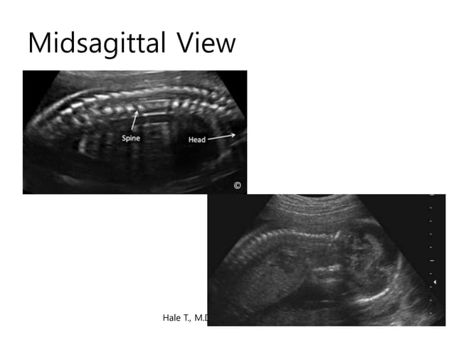 8. normal second trimester ultrasound | PDF | Pregnancy | Reproductive ...