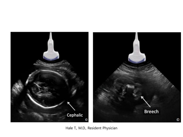 8. normal second trimester ultrasound | PDF | Pregnancy | Reproductive ...
