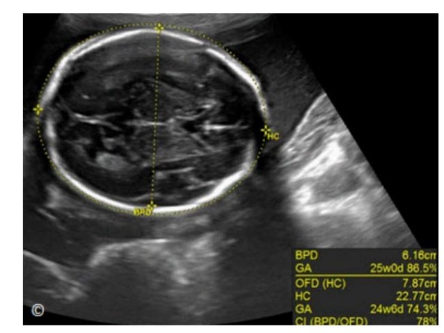 8. normal second trimester ultrasound
