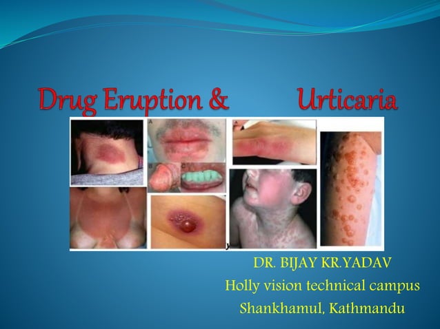 8. Drug eruption & urticaria | PPT