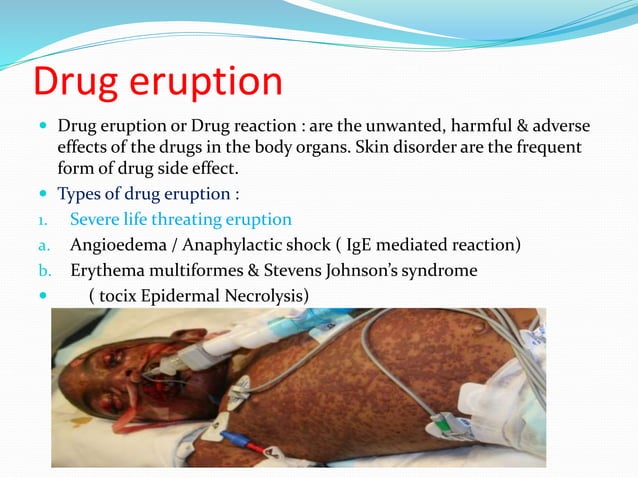 8. Drug eruption & urticaria | PPT