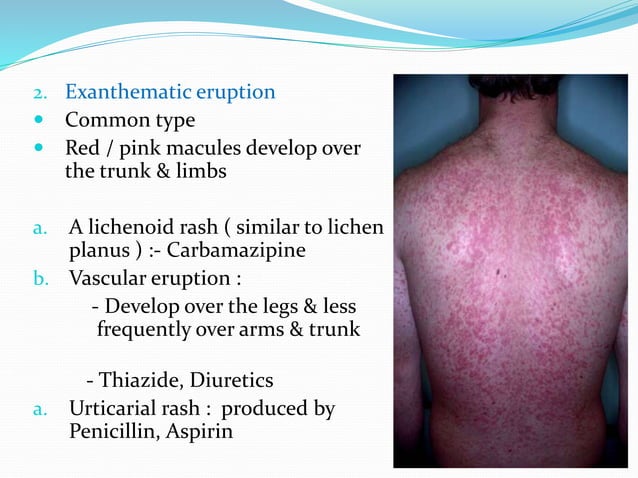 8. Drug eruption & urticaria | PPT