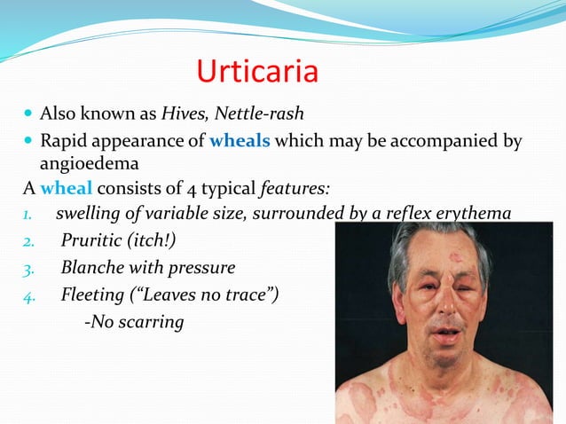 8. Drug eruption & urticaria | PPT