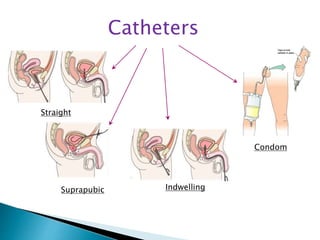 Indwelling Catheter Vs Intermittent