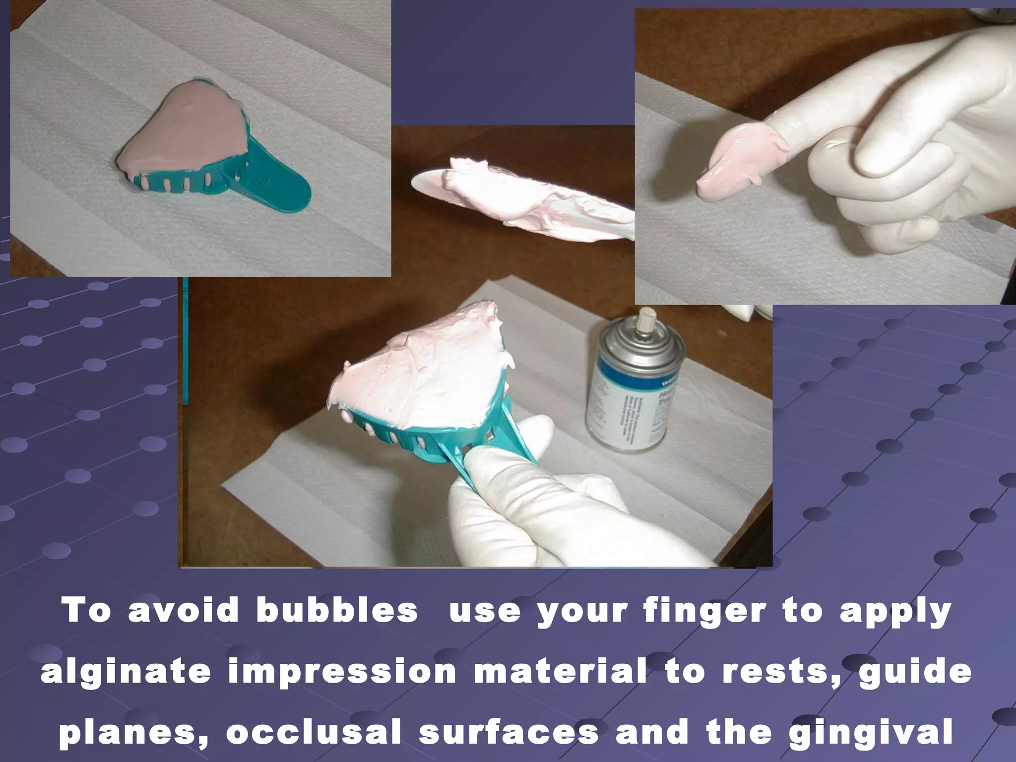 6. final impression techniques for removable partial dentures | PPT