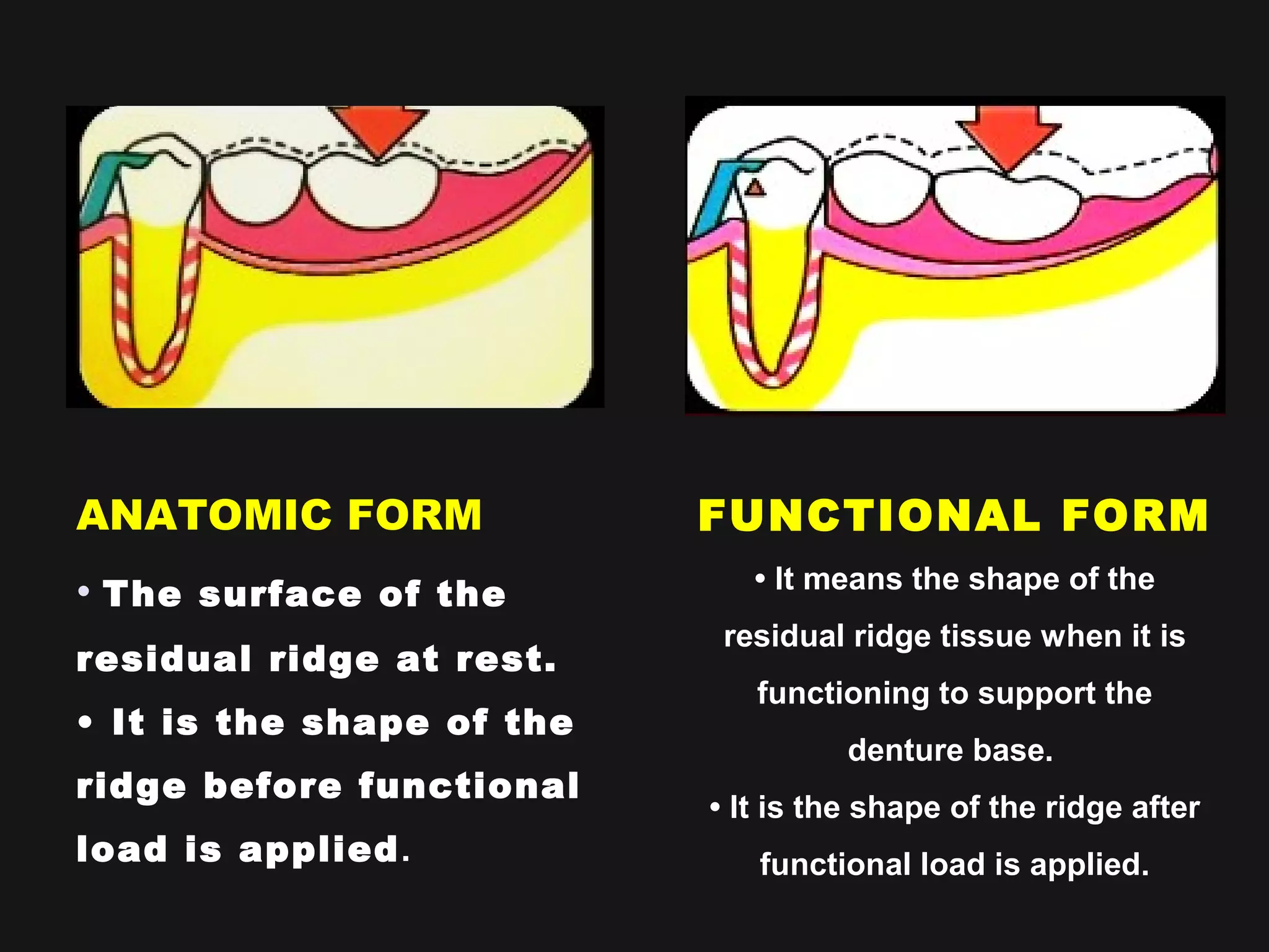 6. final impression techniques for removable partial dentures | PPT
