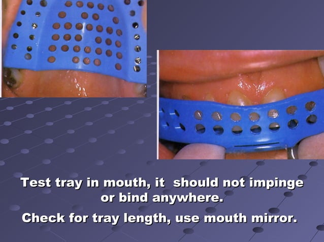 6. final impression techniques for removable partial dentures | PPT