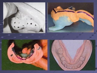 6. final impression techniques for removable partial dentures | PPT