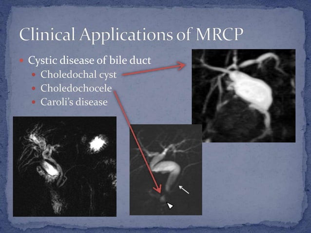Magnetic Resonance Cholangiopancreatography (MRCP) | PPTX