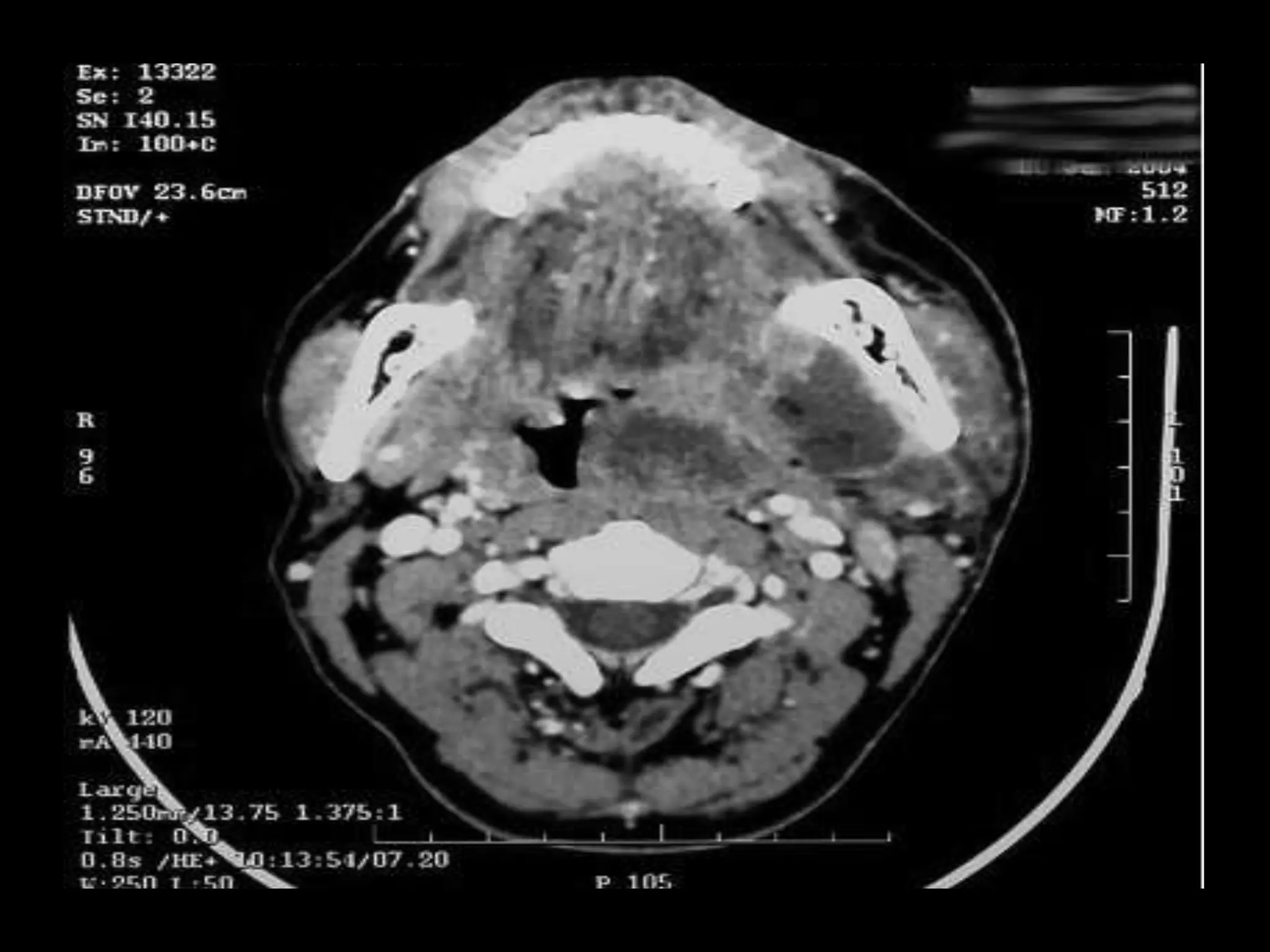 Deep neck space infections | PPT