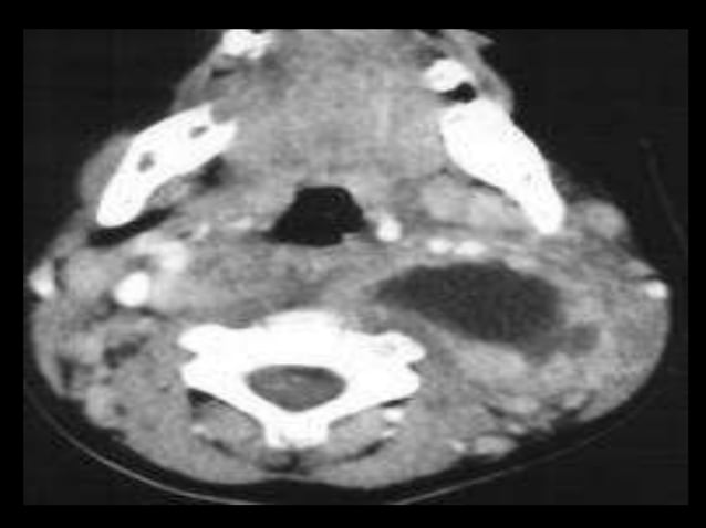 Deep neck space infections | PPT