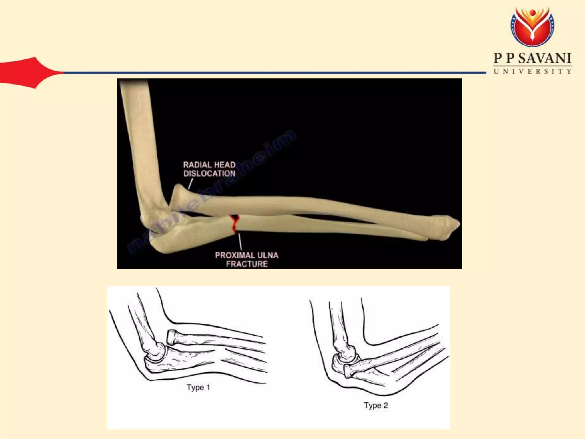 8. Forearm bone fractures | PPTX
