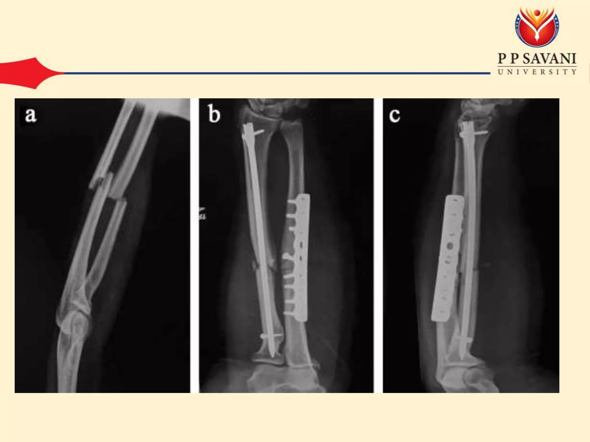 8. Forearm bone fractures | PPTX