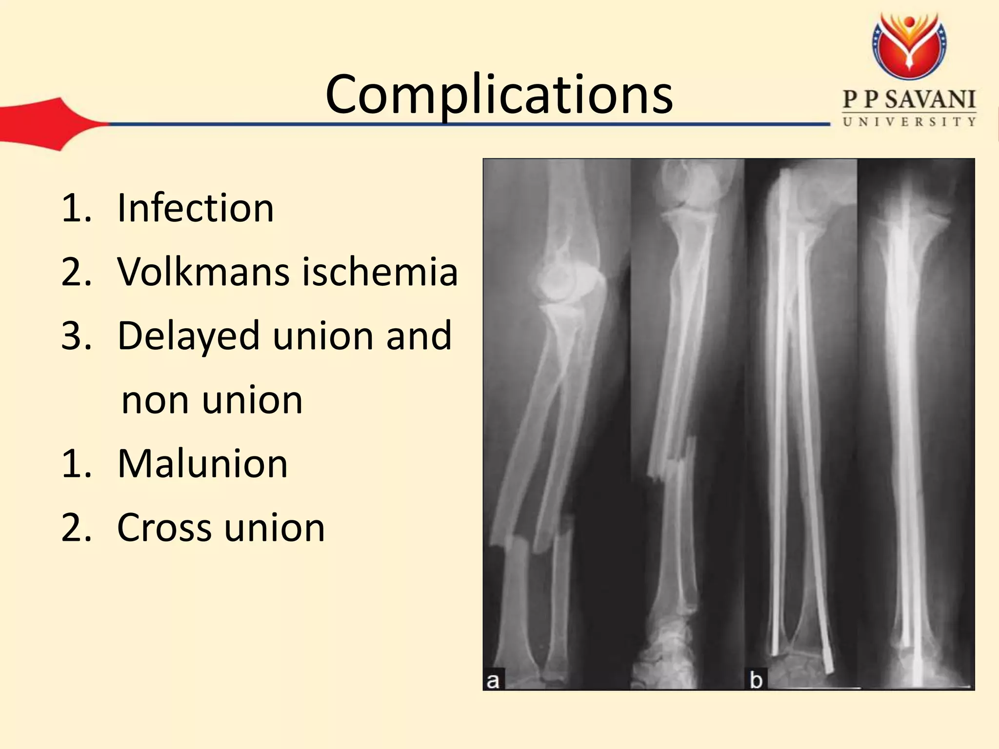 8. Forearm bone fractures | PPTX