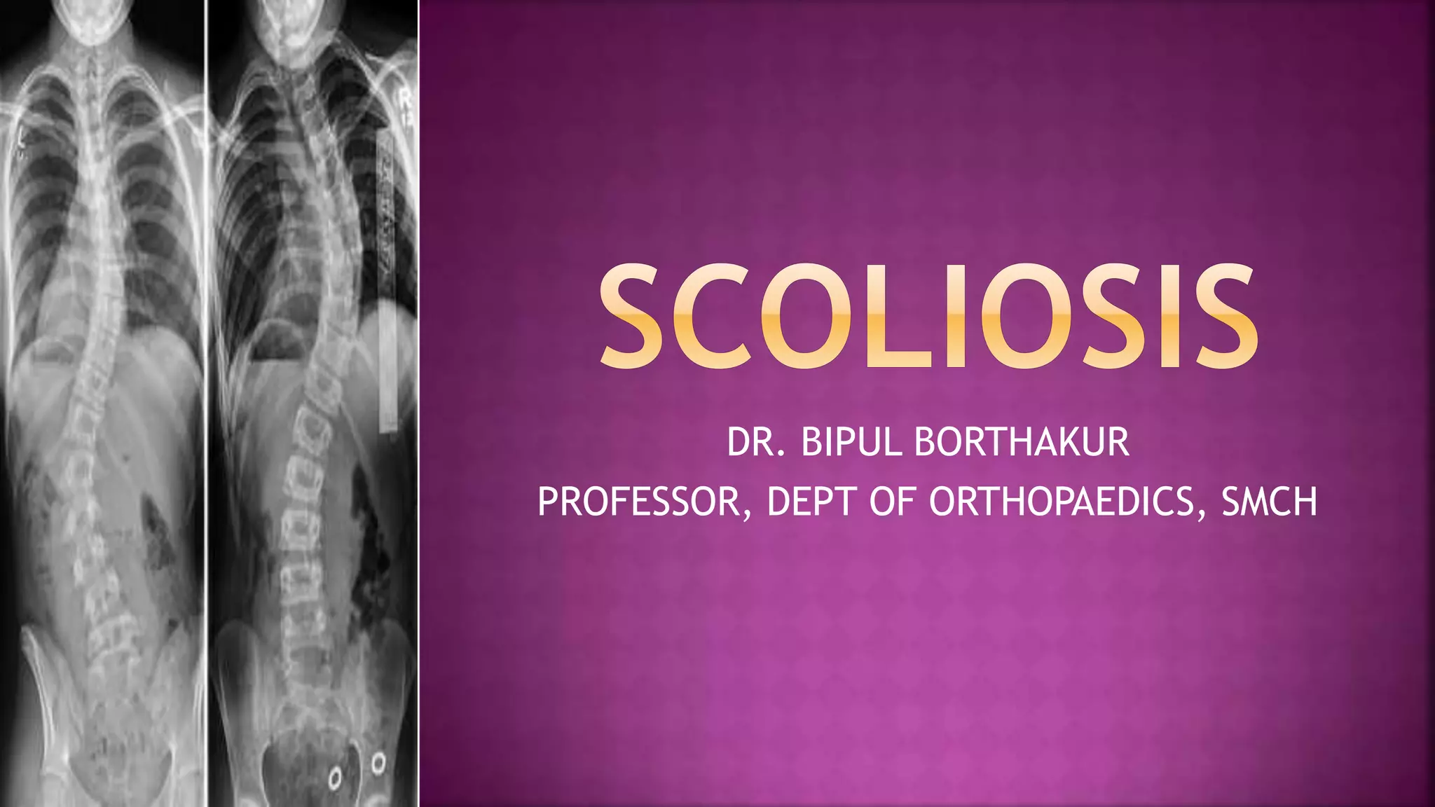 Scoliosis | PPTX