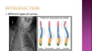 Scoliosis | PPTX