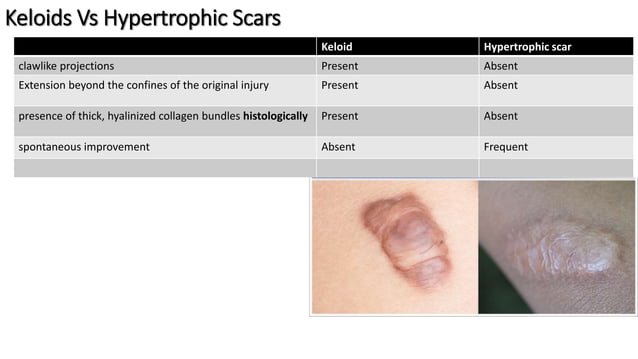8.keloid | PPTX | Skin and Dermatology | Diseases and Conditions